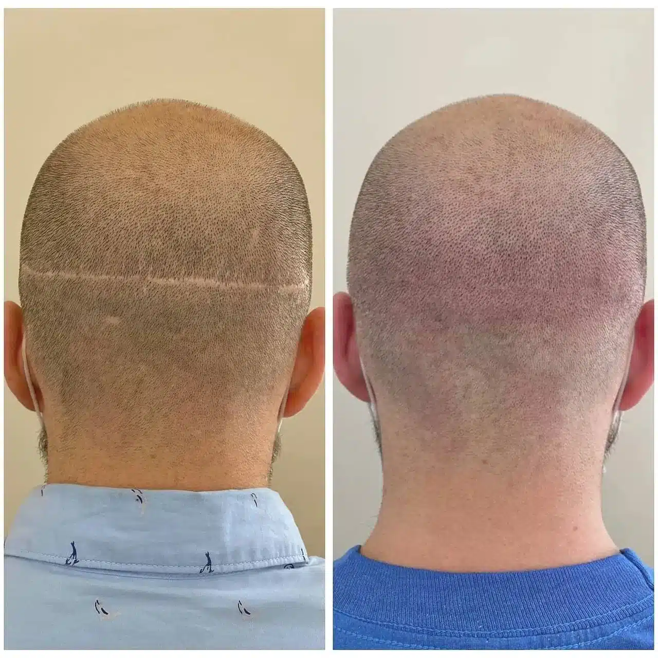 Combining SMP and FUE – A Powerful Duo for Hair Restoration - SMP Clinic