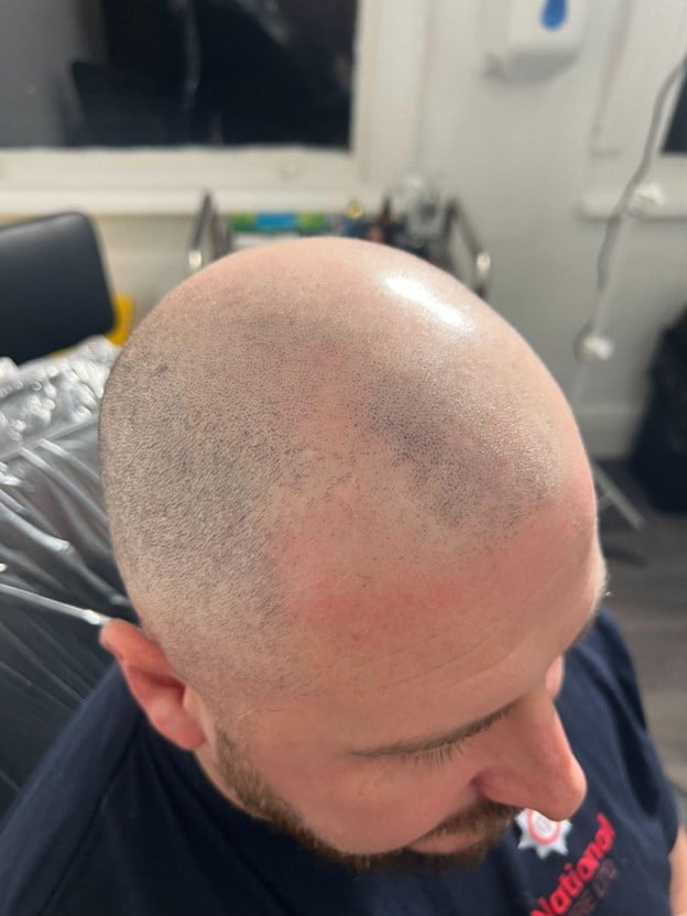 SMP for Men | Scalp Micropigmentation Manchester & UK | SMP-Clinic